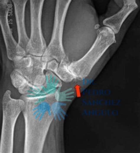 Artrosis De Manos Produce Dolor E Incapacidad