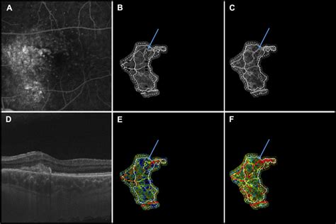 Multimodal Longitudinal Imaging Of Chronic Choroidal Neovascularization Download Scientific