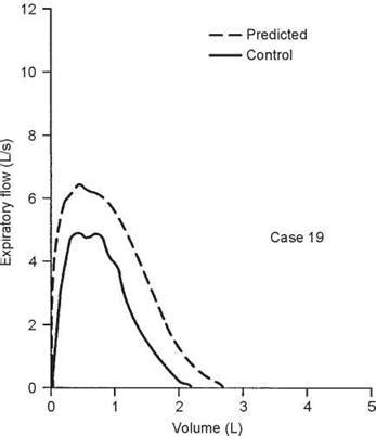 Illustrative Cases Interpretation Of Pulmonary Function Tests A Practical Guide 3 Ed