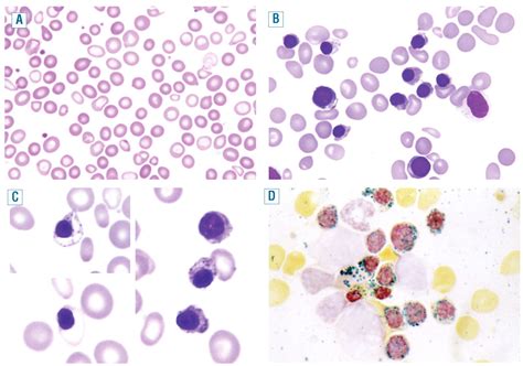 Ringed Sideroblasts Vs Basophilic Stippling