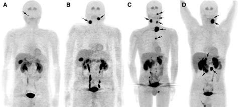 Paraganglioma Tumor Causes Symptoms Diagnosis Treatment