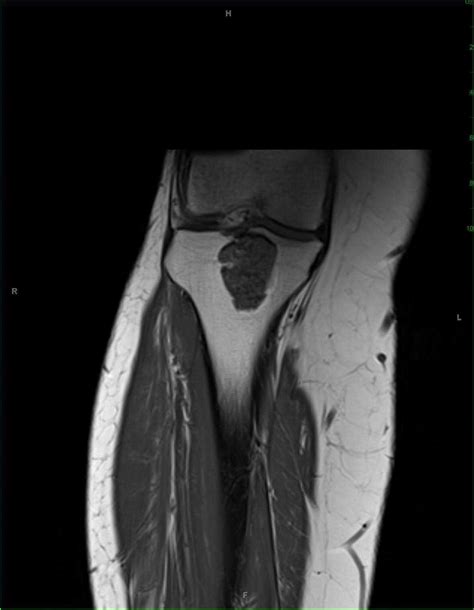 Enchondroma Tibia Musculoskeletal Radiology Case Studies Ctisus Ct