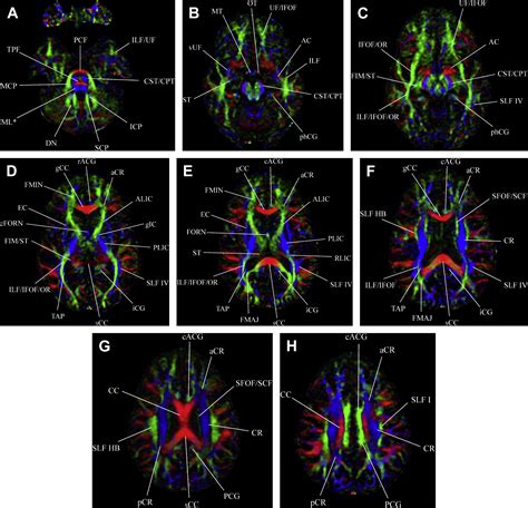 Preoperative Diffusion Tensor Imaging Neuroimaging Clinics