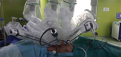 Robot Assisted Laparoscopic Pyeloplasty A Retrospective Cas Journal Of Minimal Access Surgery