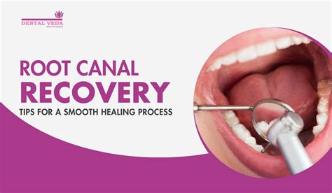 Root Canal Recovery Tips For A Smooth Healing Process