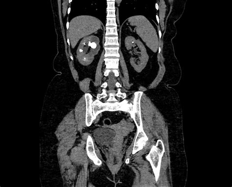 Deteksi Batu Ginjal Object Detection Dataset And Pre Trained Model By TugasAkhir2