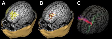 Video Neuroimaging Guided Tms Eeg For Real Time Cortical Network Mapping