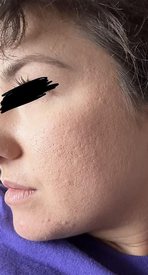 Thoughts On Skin How To Get Rid Of Texture R 30plusskincare