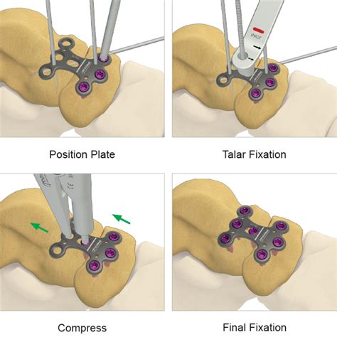 Talonavicular Fusion Plate Trimed Inc