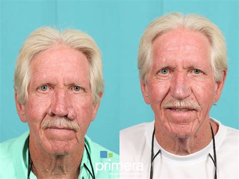 Co2 Laser Skin Resurfacing For Orlando And Winter Park Fl Primera