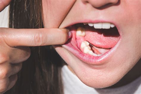 Tooth Replacement Options Adelaide Oral Path