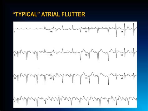 Atrial Flutter Causes Definition Fetisos