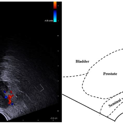 Ppb 5 Ml Of 1 Lidocaine Was Injected Into The Region Of The Pelvic Download Scientific