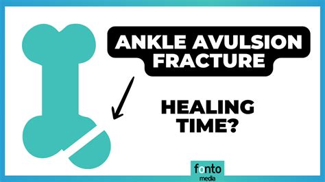 Avulsion Fracture Healing Time At Jordan Rivas Blog