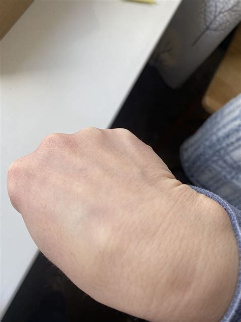 Появилась шишечка на запястье что это Советчица