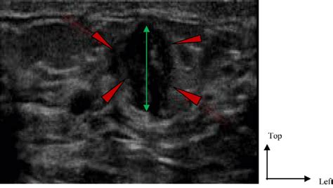 Irregular Hypoechoic Mass Red Arrow Head With Long Vertical Axis Download Scientific Diagram