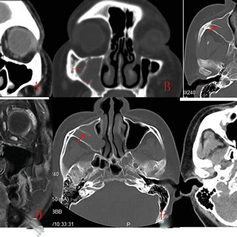 39 Years Female The First Preoperative Ct Revealed Hyperostosis And