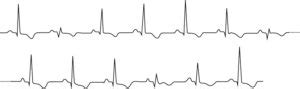 Eletrical Alternans The Ecg In Pericardial Effusion And Cardiac