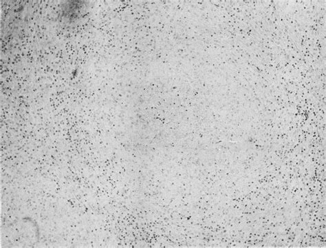 Caseating Epithelioid Cell Granuloma In The Mesenteric Mass