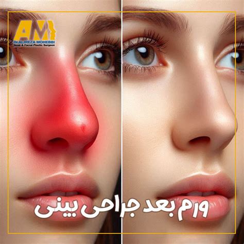 ورم بعد جراحی بینی چگونه از بین می رود؟ دکتر علیرضا محبی