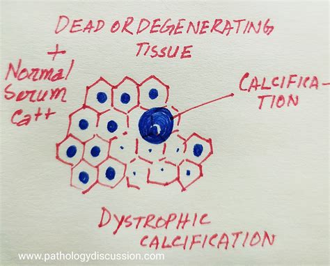 Faq On Pathologic Calcification Dystrophic Calcification Metastatic