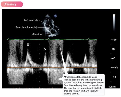 Pulsed Wave Doppler The Cardiovascular