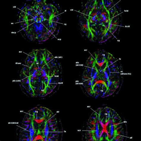 Diffusion Tensor Mr Images In 12 Year Old Health Boy Color Coded White