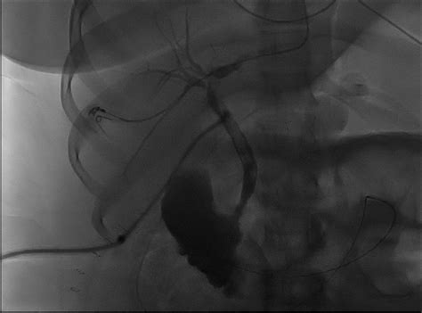 T Tube Cholangiogram Obtained Days Following Surgery Demonstrating Download Scientific