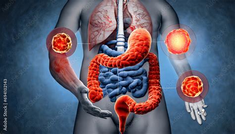 Foto De Large And Small Intestine Colon Cancer Bacteria Inflammation