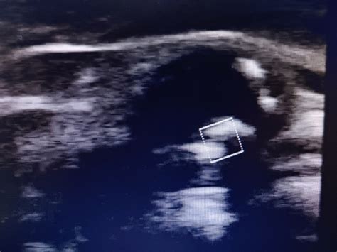 Cypress Early Detection Cardiovascular Imaging Program Cypress Heart