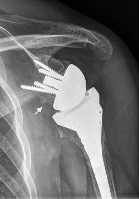 Post Operative Radiograph Reverse Shoulder Arthroplasty With Scapular Download Scientific