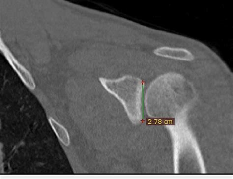 Measurement Of The Glenoid Height In The Superior Inferior Direction On Download Scientific