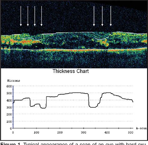 Figure 1 From Boundary Detection Errors On Optical Coherence Tomography Images In Patients With