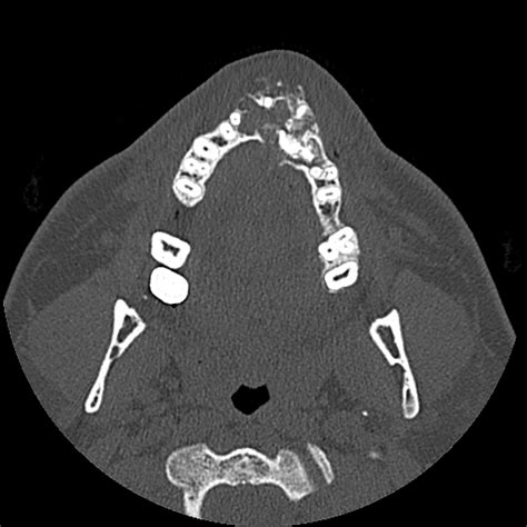 Calcifying Epithelial Odontogenic Tumor