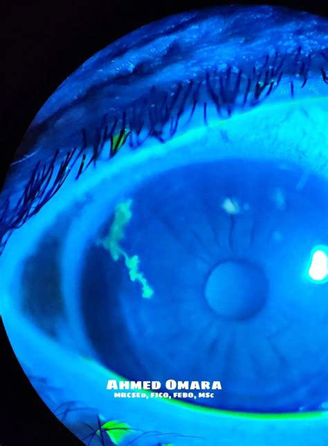 Ahmed Omara On Linkedin Dendritic Ulcer