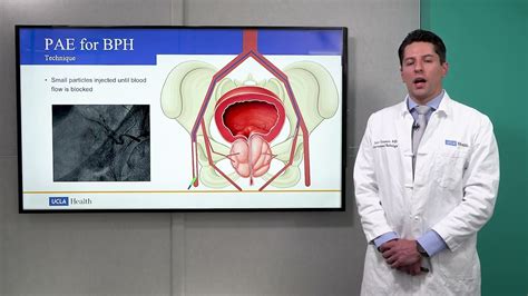 Prostatic Artery Embolization Procedure Technique Lucas R Cusumano Md Mph Youtube