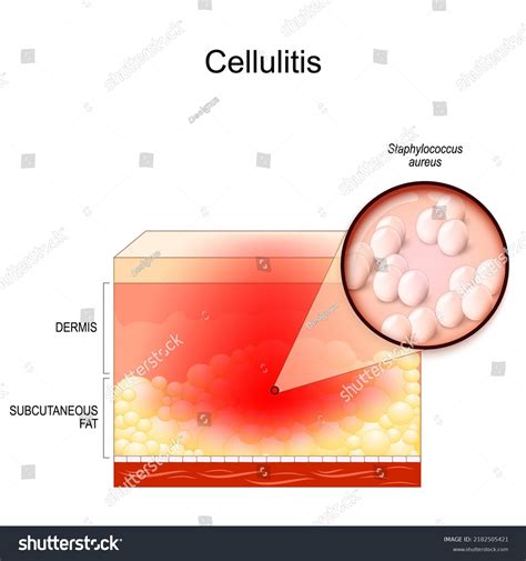 Skin Abscess Diagram