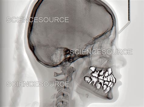 Normal Teeth 3d Cbct Scan Stock Image Science Source Images