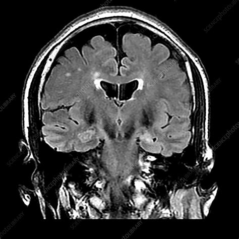 Mesial Temporal Sclerosis Mri Stock Image C039 4237 Science Photo Library
