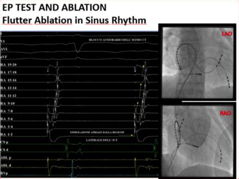 Atrial Flutter Afl Ablation Af Ablation
