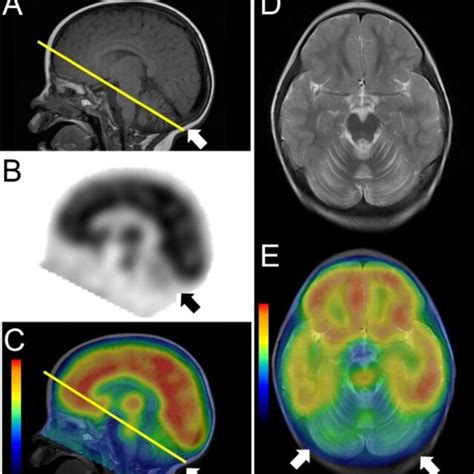 The Entire Cerebellum Showed Severe Atrophy On Brain Mri A And Much Download Scientific