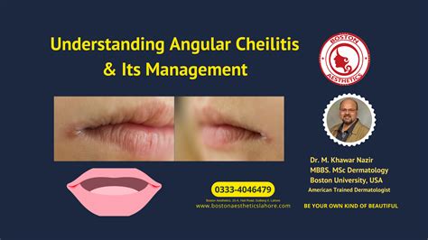 Angular Cheilitis Boston Aesthetics Angular Cheilitis Boston Aesthetics