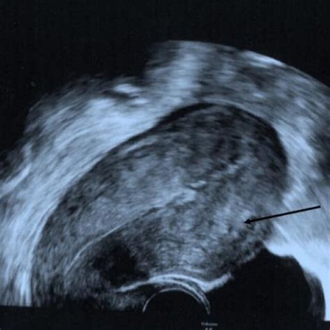 Transvaginal Ultrasound Revealed A Thin Endometrial Echo At 4 Mm With A Download Scientific