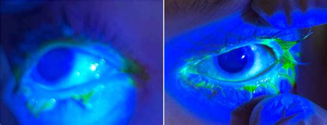 Ocular Involvement In Reactive Infectious Mucocutaneous Eruption