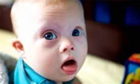 واقعیت‌هایی درباره سندروم داون