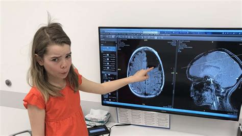 Surgery For Epilepsy Ucla Health