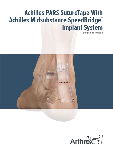 Achilles Pars Suturetape With Achilles Midsubstance Speedbridge Implant System Pdf Surgery