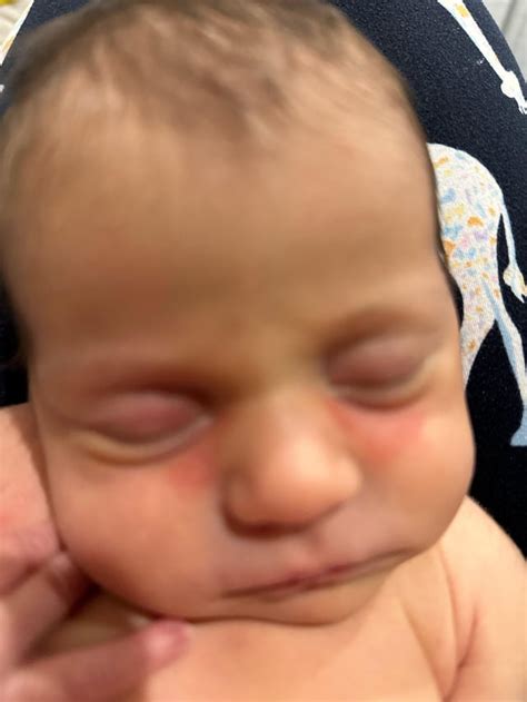 Newborn Red Under Eyes R Newborns