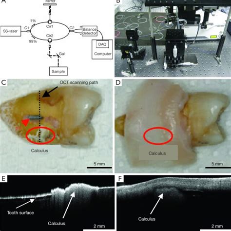 Ss Oct In Vitro Imaging Of Calculus A Illustrated Diagram Of Ss Oct