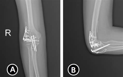 Surgical Outcomes Of Olecranon Osteotomy Approach Combined With